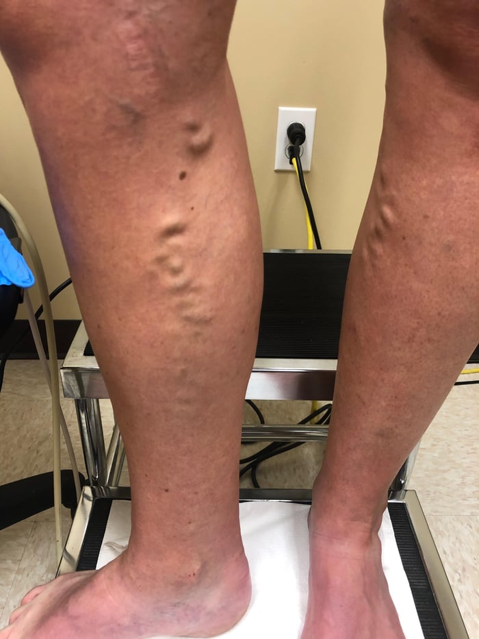 Varicose Veins vs Prominent Veins: Differences, Risks & Vein Care