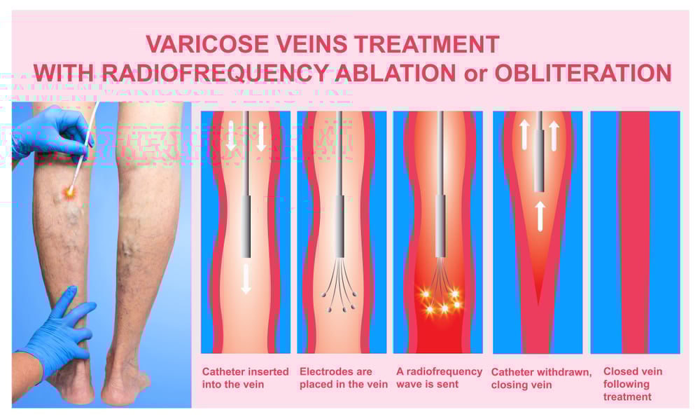 Understanding Vein Treatment: Endovenous Ablation vs. Sclerotherapy