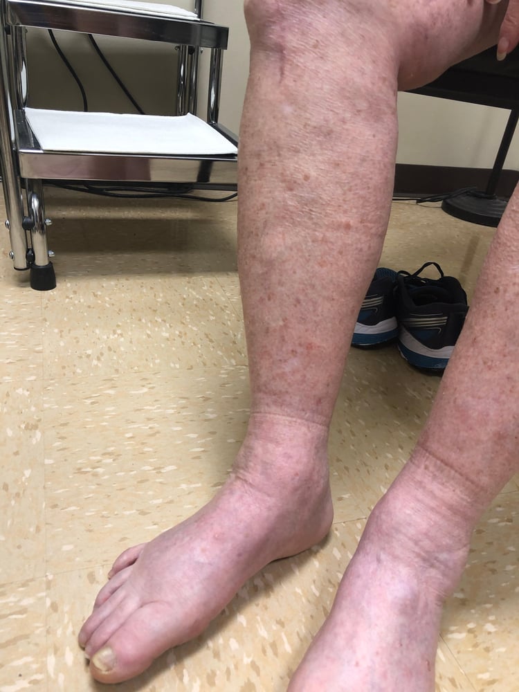 Leg Swelling? Vein Care in Missouri