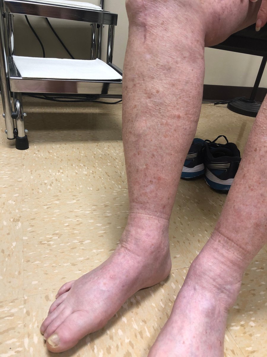 Leg Swelling? Vein Care in Missouri