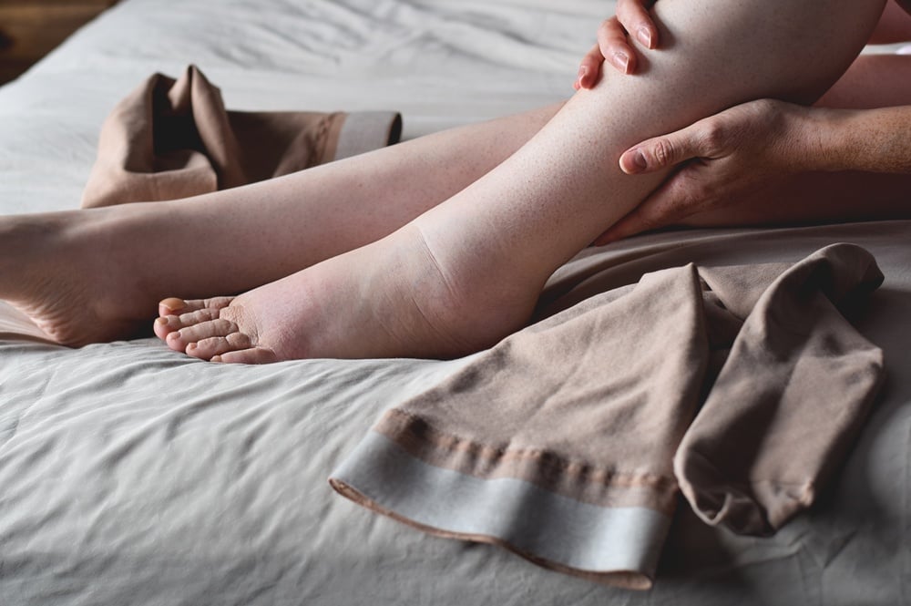 A Guide to Understanding Leg Edema: What's Causing Your Swelling?