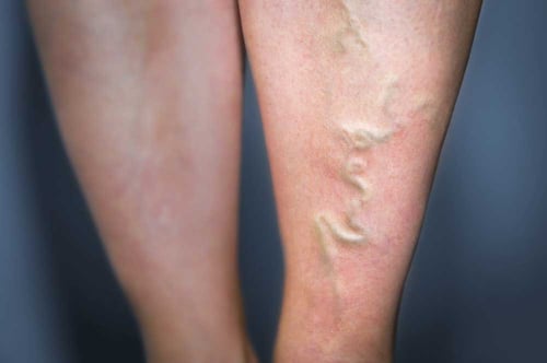 Bulging Veins? 5 Reasons Your Veins Pop Out in Legs & Arms