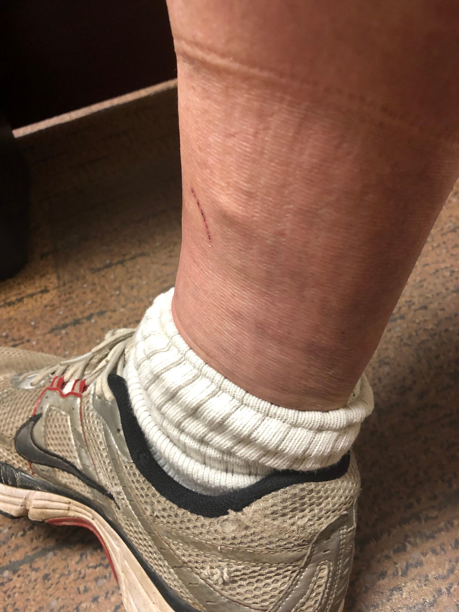 Understanding the Five Types of Abnormal Veins