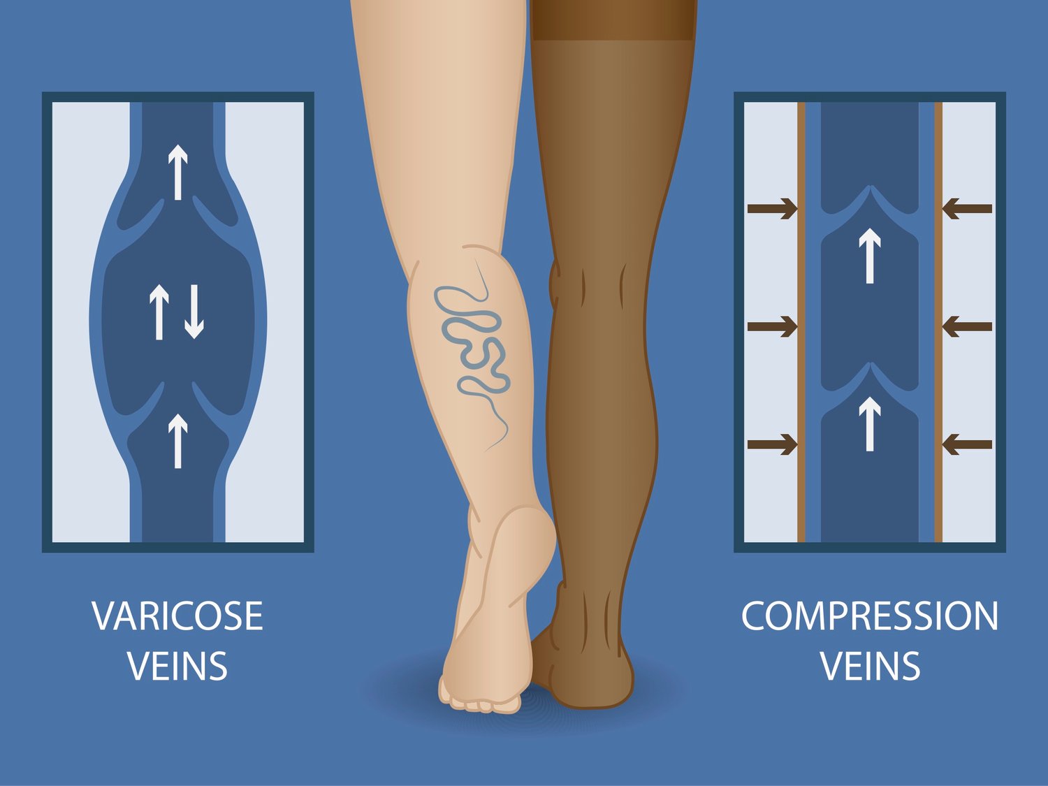 Compression Stockings: What Are They & Do They Really Work? Compression Stockings: What Are They & Do They Really Work?
