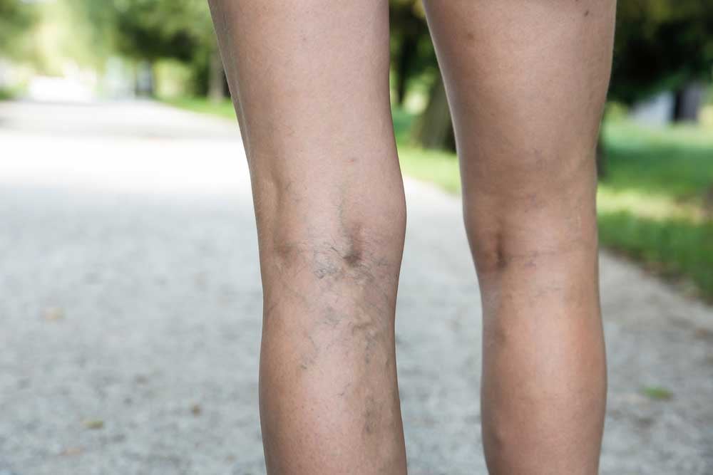 Different Types of Leg Veins and How Vein Care Helps