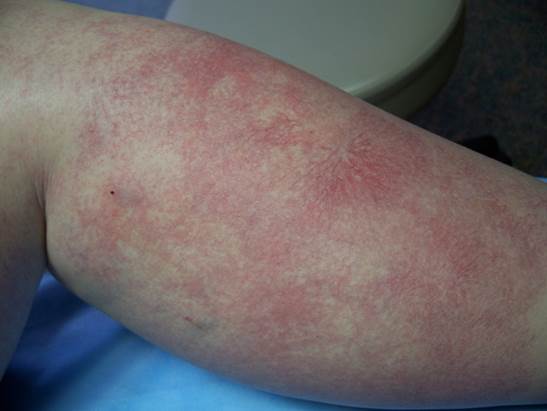 Understanding the Five Types of Abnormal Veins