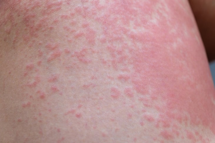 Could Your Leg Rash Be a Sign of a Vein Problem? Missouri Vein Care