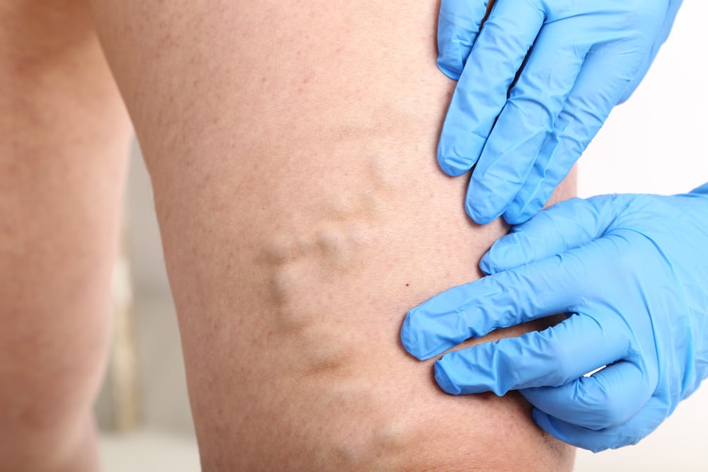 Understanding Vein Treatment: Endovenous Ablation vs. Sclerotherapy