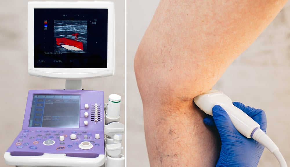 What to Expect at Your First Vein Screening